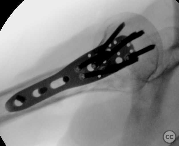 Subacute 2 part proximal humerus fracture