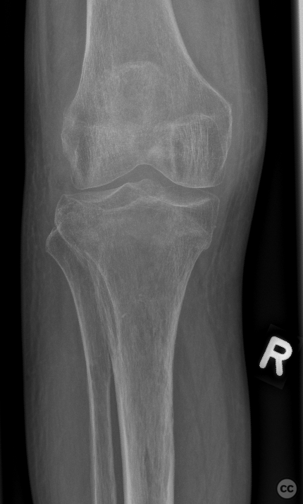Proximal Tibia Hyperextension Fracture in an Osteopenic Patient
