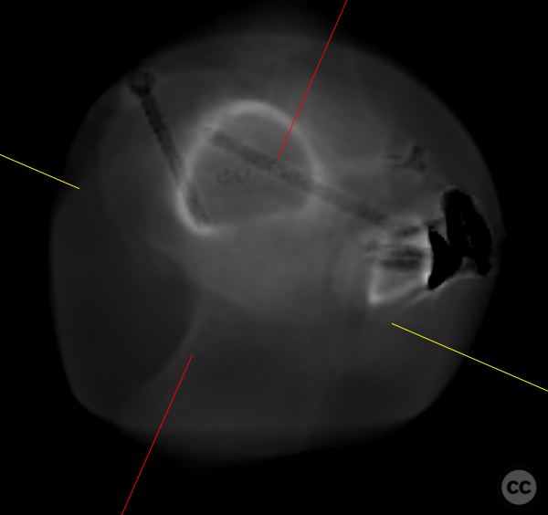 Chaput tubercle fracture in an adult bimalleolar ankle fracture