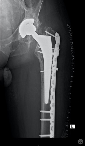 Periprosthetic fracture