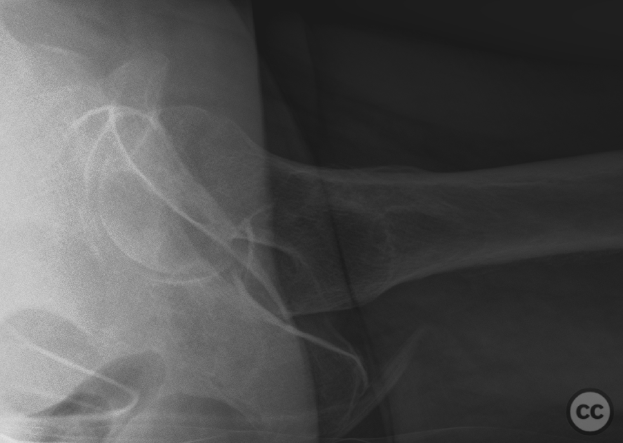 Cannulated screw fixation of a Garden I subcapital femoral neck fracture