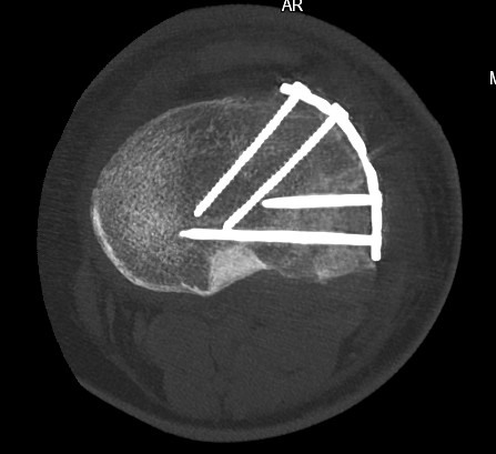 Posterolateral rim-plate Schatzker 2 tibial plateau