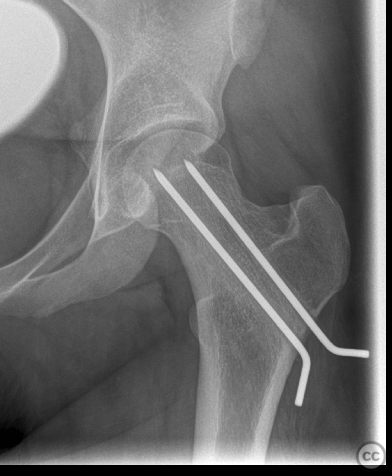 SCFE - longitudinal images over 6 years: 10-16years old