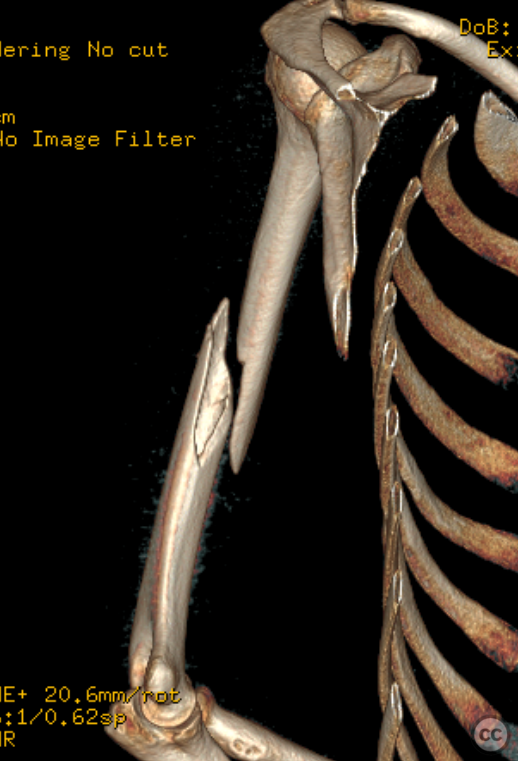 Aggregate lateral approach to a long segmental spiral humerus fracture