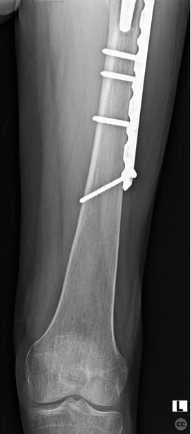 Periprosthetic fracture