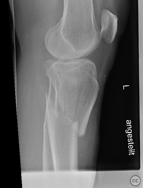 Combined tibial metaphysis and plateau fracture