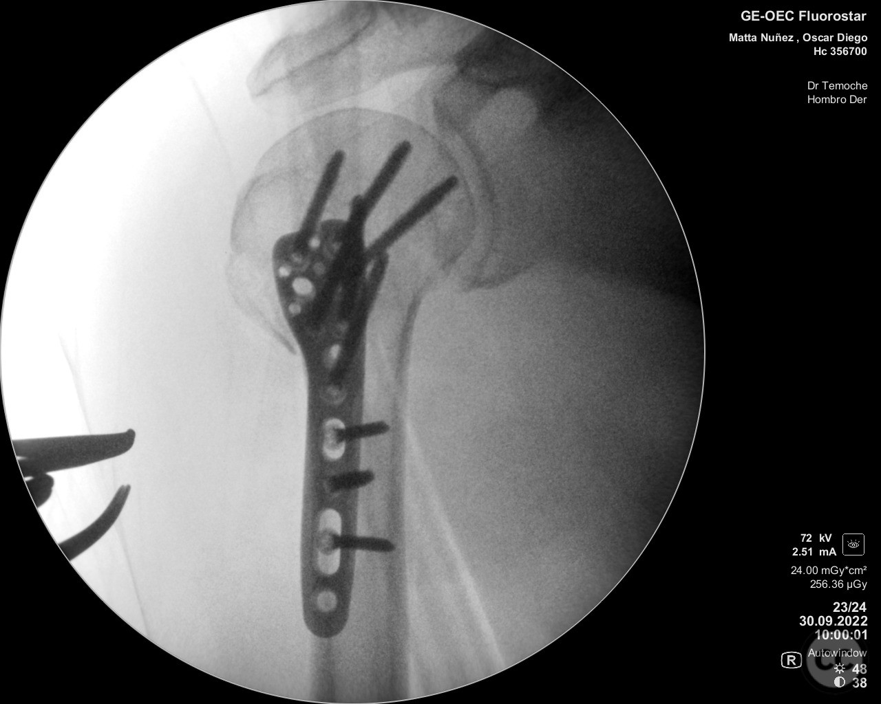 Orif Proximal Humerus Plate