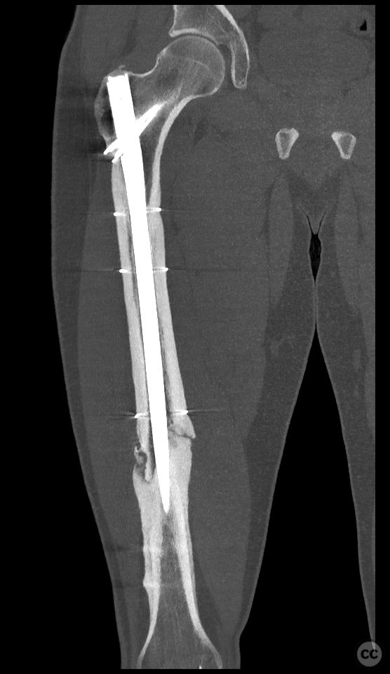 Closed segmental comminuted femoral fracture