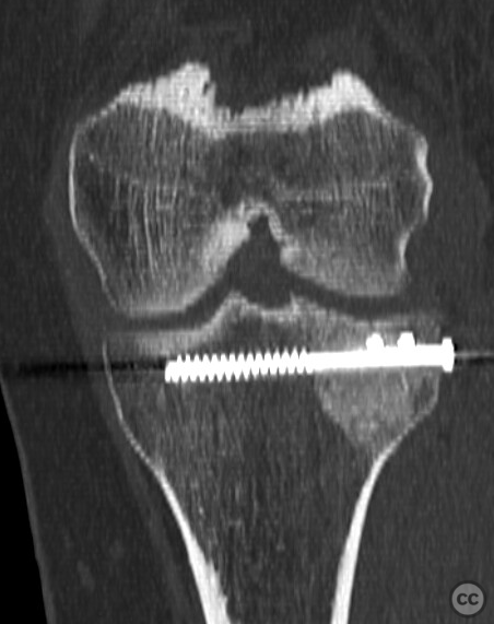Jail-screw fixation posterolateral plateau impression fracture