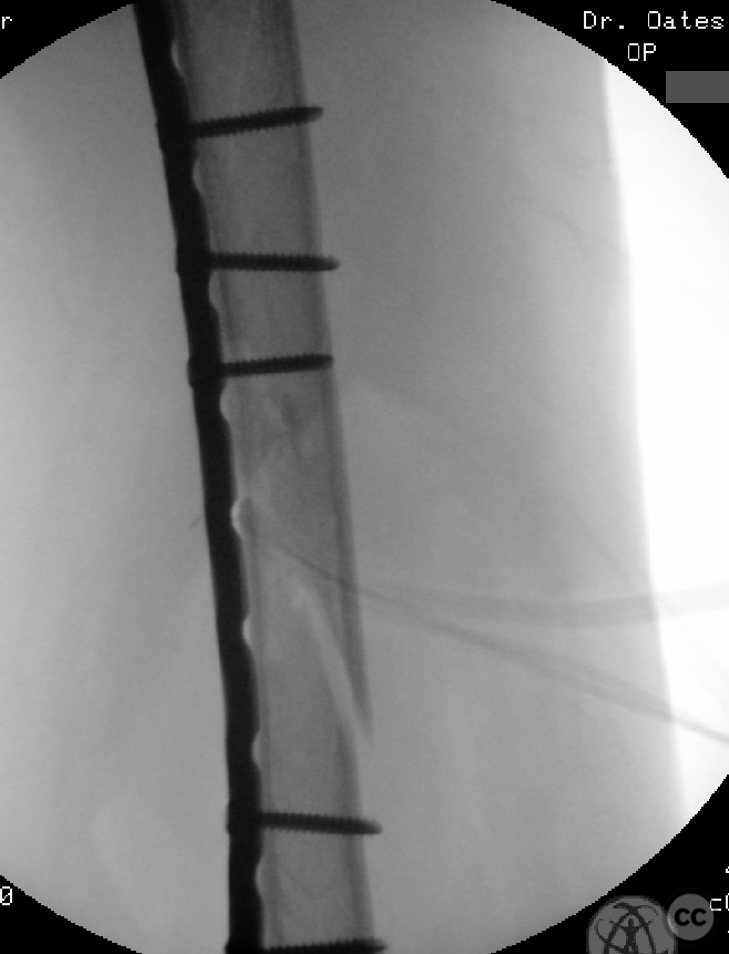 Aggregate lateral approach to a long segmental spiral humerus fracture
