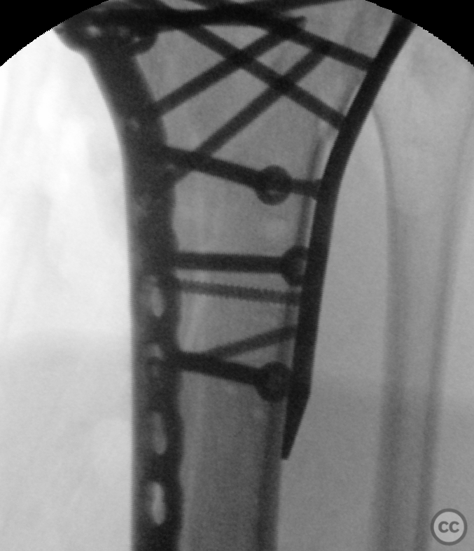 Schatzker 6 tibial plateau with lateral femoral epicondyle osteotomy
