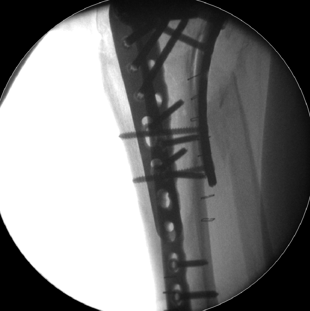 Schatzker VI tri-condylar fracture with pseudo PLC disruption