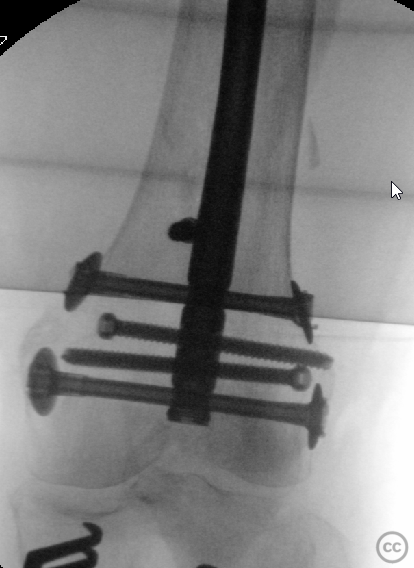 Retrograde SCN plus Poller screw for a distal 1/3 femoral diaphyseal ...