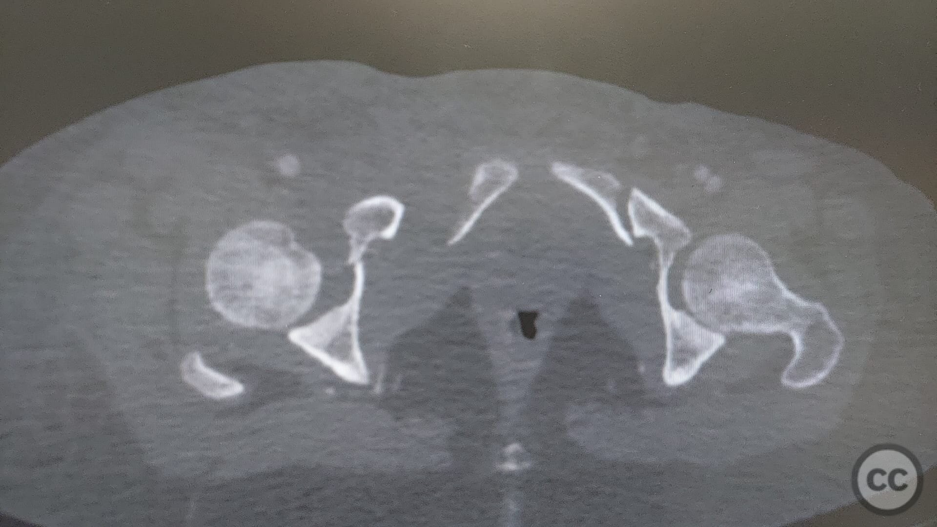 Acetabulum, sacrum, pubic ramus - earthquake crush injury