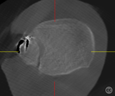 SER ankle injury with occult PITFL + deltoid instability