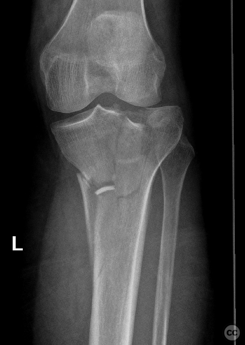 Subluxed Moore 2 / Schatzker IV tibial plateau fracture