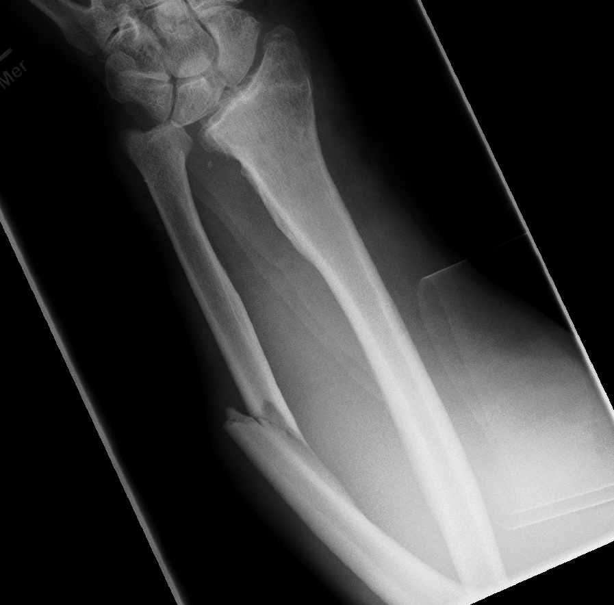 Essex-Lopresti fracture-dislocation