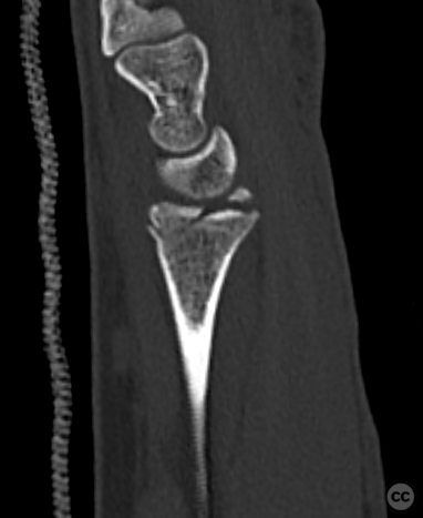 Operative Management of Chauffeur's Fracture with Intraarticular ...