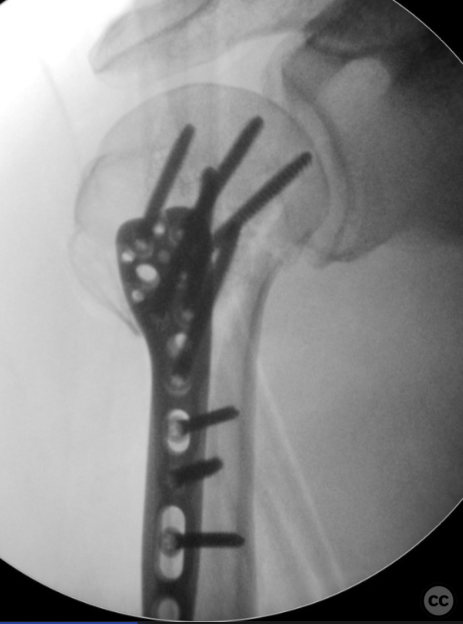 ORIF proximal humerus plate