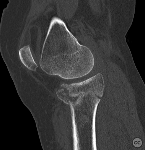 Varus hyperextension tibial plateau fracture