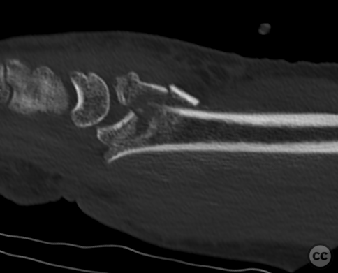 Complex comminuted and impacted distal radius fracture