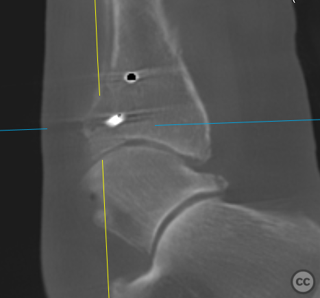 Chaput tubercle fracture in an adult bimalleolar ankle fracture