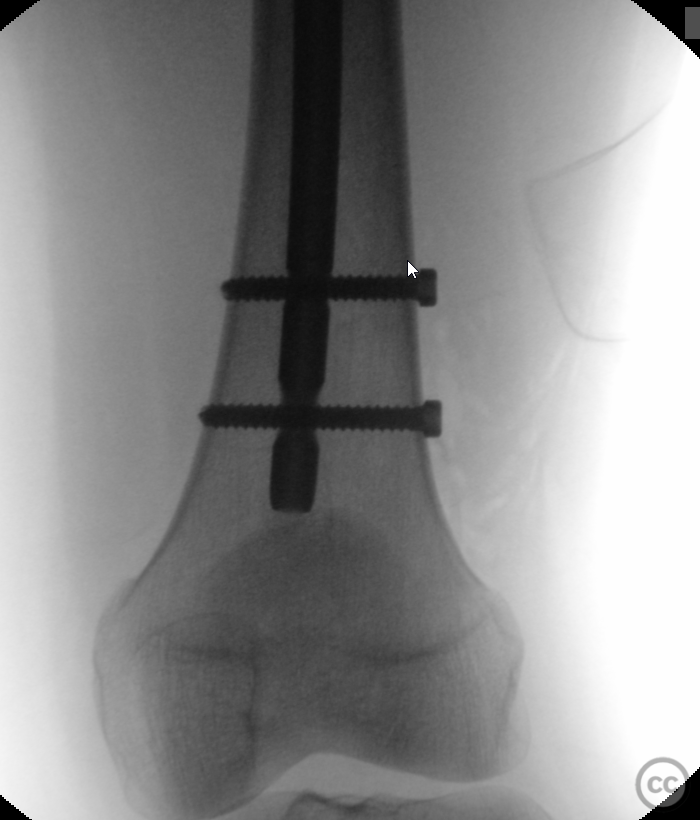 Simple transverse femoral shaft fracture