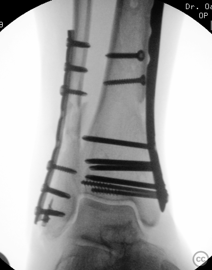 Combined distal 1/3 tibia fracture with SAD bimalleolar ankle fracture
