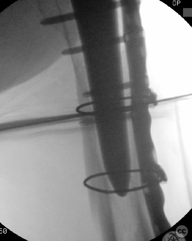 Vancouver B2 periprosthetic femur fracture - NCB plating + cerclage