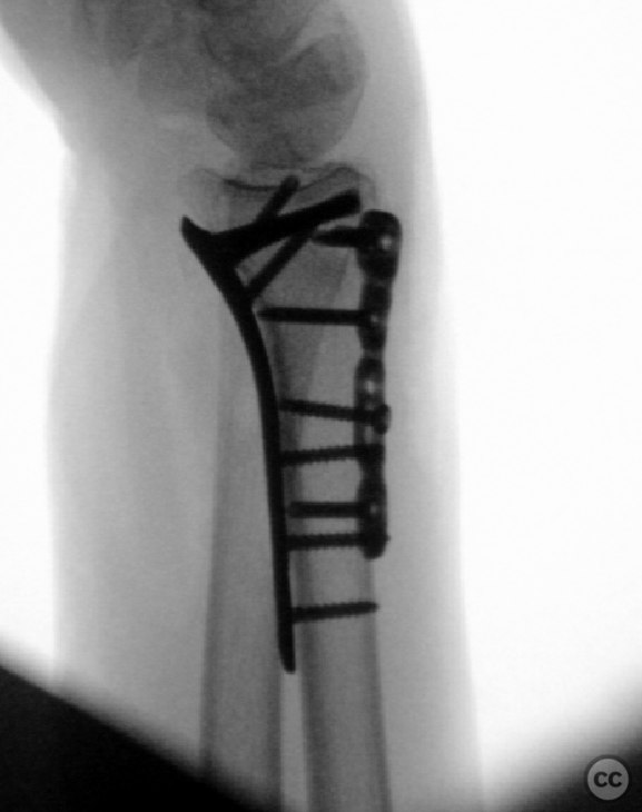 Dorsal plate fixation of the dorsoulnar fragment in a C3 radius fracture