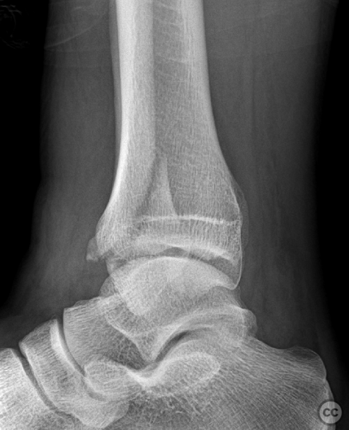 SER ankle injury with occult PITFL + deltoid instability