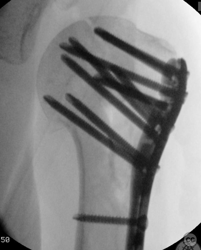 Impacted anatomical neck of humerus fracture with TM fragment