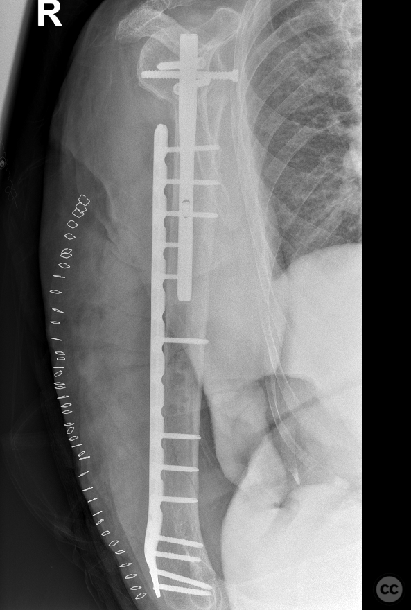 Displaced surgical neck of humerus fracture with brachial plexus ...