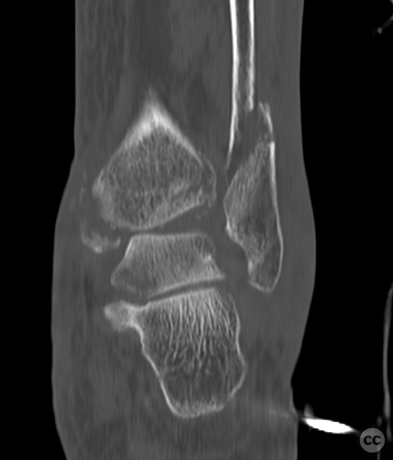 Pronation Abduction (PAb) ankle fracture with Mason 2A lateral plafond ...