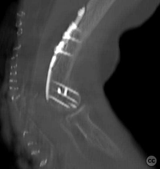 Transolecranon Dubberly 2B fracture dislocation