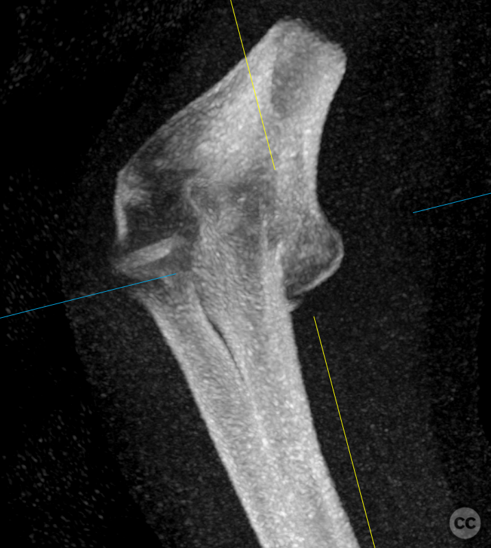 PMRI following elbow dislocation with pMCL insufficiency