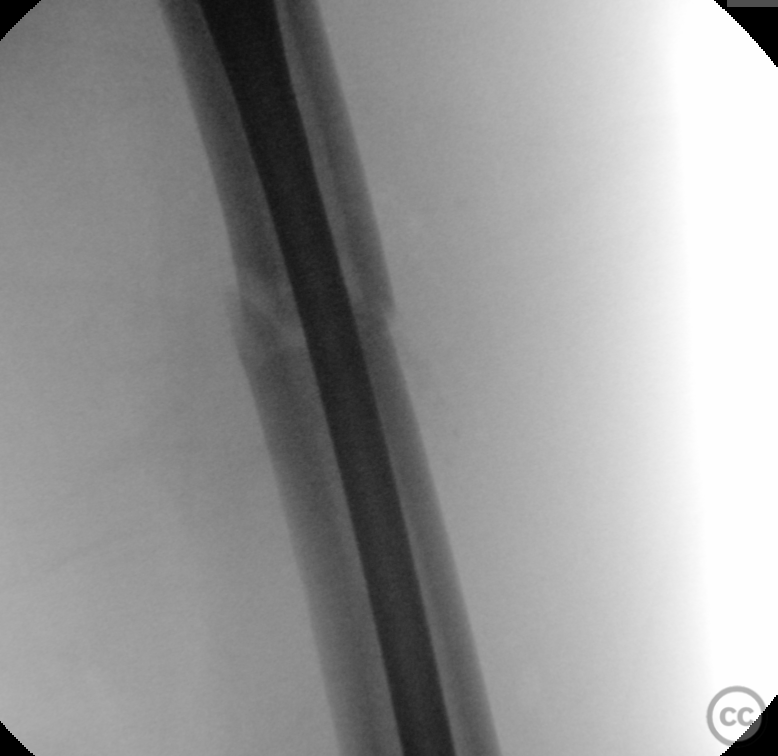 Simple transverse femoral shaft fracture