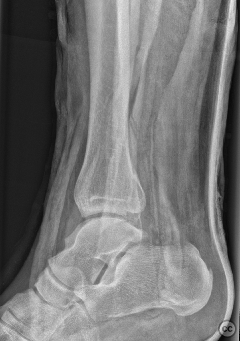 Mason III posterior malleolus fracture dislocation
