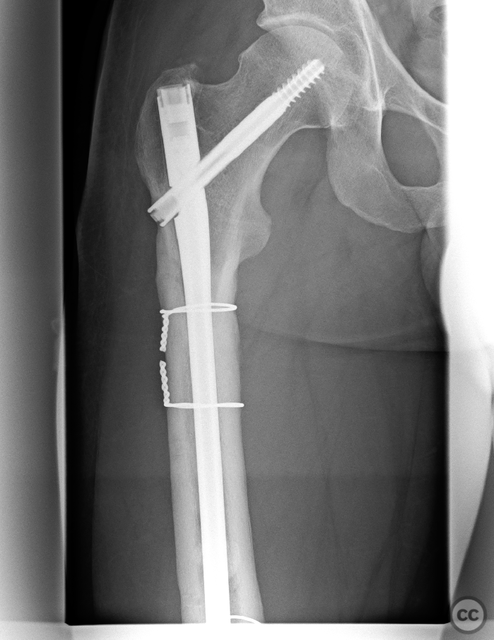 Closed segmental comminuted femoral fracture
