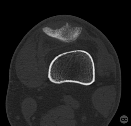 Comminuted patella fracture with inferior pole avulsion