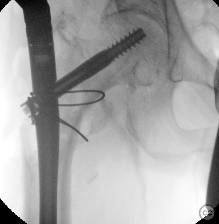 Failure of fixation - Gamma nail cut-out and arthroplasty revision