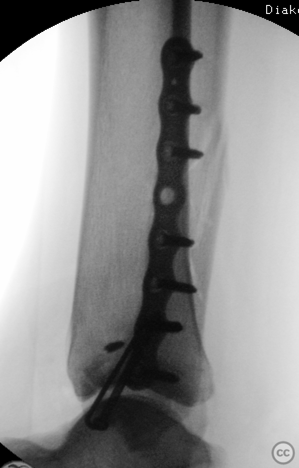 Pronation Abduction (PAb) Weber C / Herscovici B bimalleolar ankle fracture
