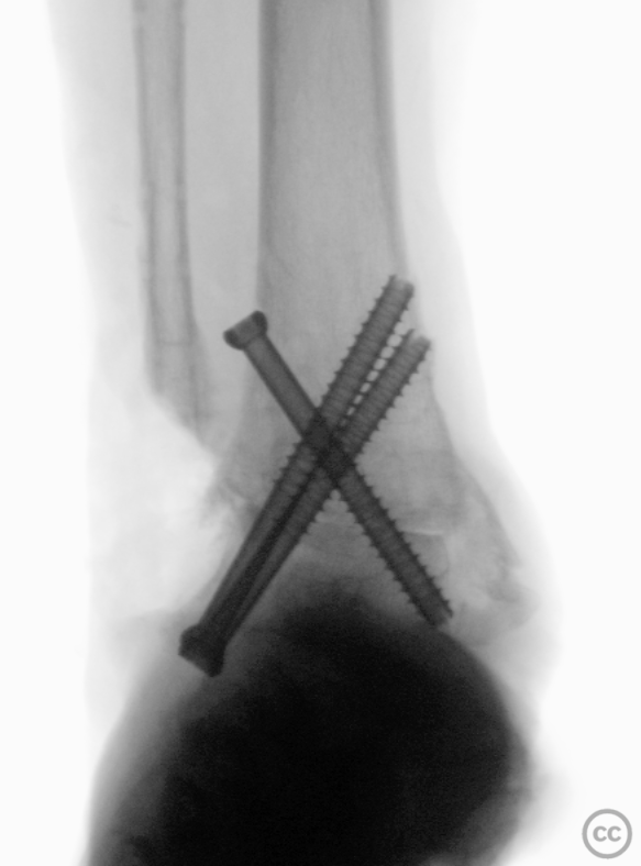 Failed pronation - external rotation (PER) ankle fracture dislocation