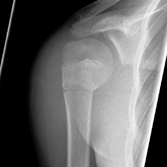 Proximal humerus metaphyseal fracture