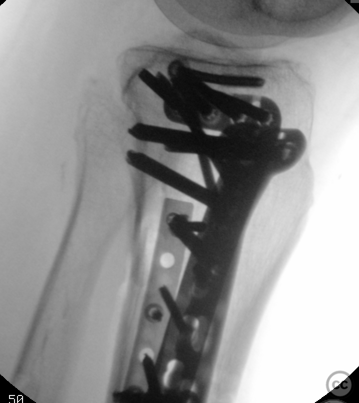 Combined tibial metaphysis and plateau fracture