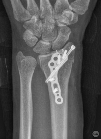 Operative Management of Chauffeur's Fracture with Intraarticular ...