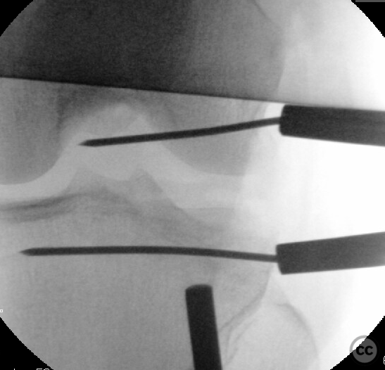 Jail-screw fixation posterolateral plateau impression fracture
