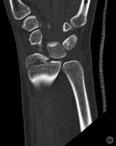 Operative Management of Chauffeur's Fracture with Intraarticular ...