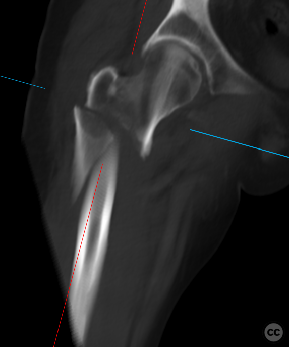 Hardware Failure of Primary Gamma Nail Osteosynthesis in ...