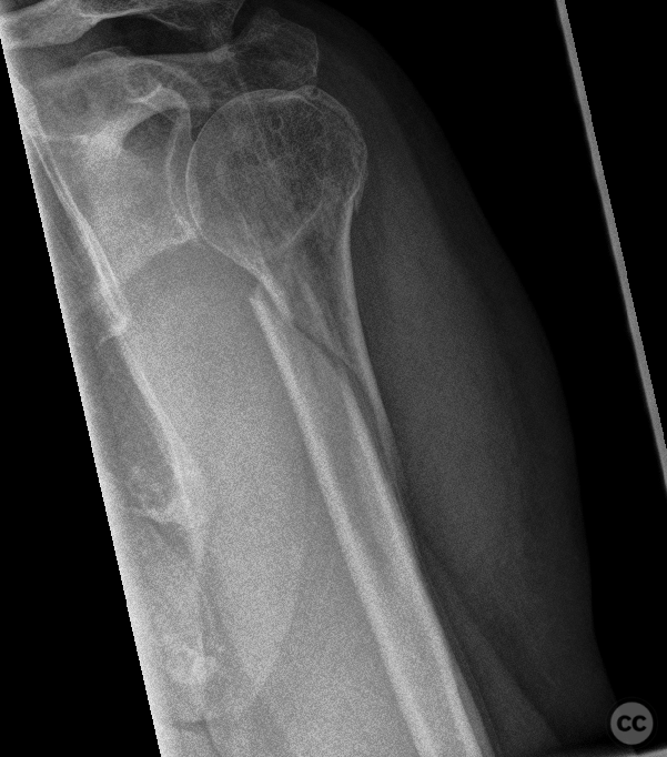 Anterolateral Helix plate - segmental proximal humerus fracture